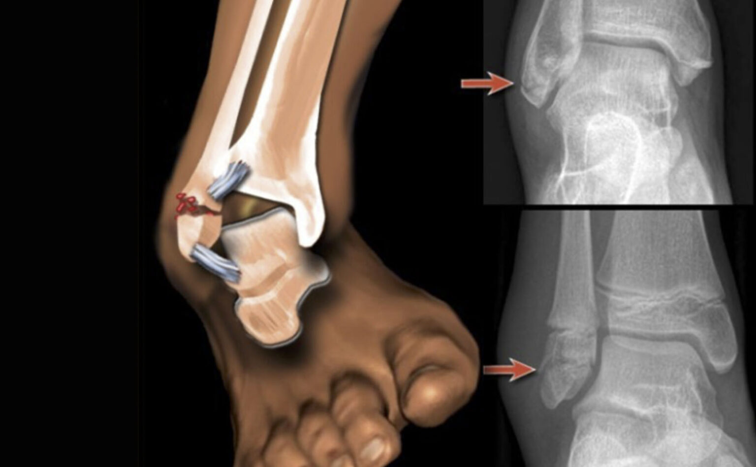 Fractura de glezna – Kinetomedical